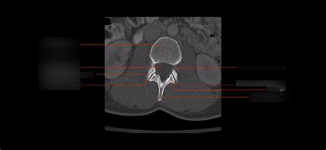 Spinous Process Diagram Quizlet