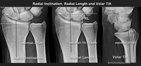 Frykman Classification Of Distal Radial Fractures Uw Emergency Radiology