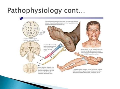 Tetanus Prophylaxis And Types Of Immunitynewnewv Pptx Infectious Tetanus Prophylaxis And Types Of Immunitynewnewv Pptx Infectious