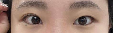 자유수다 쌍꺼풀 세미아웃라인 강남언니 1등 성형수술and피부시술 정보앱