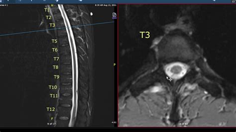 Cervical Spine Mri Ms