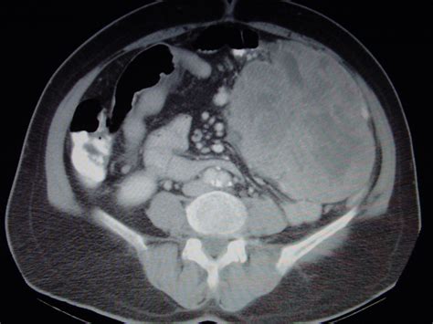 Stomach Neoplasm Gist 4367 Stomach Gist B 1 Surgery Photos