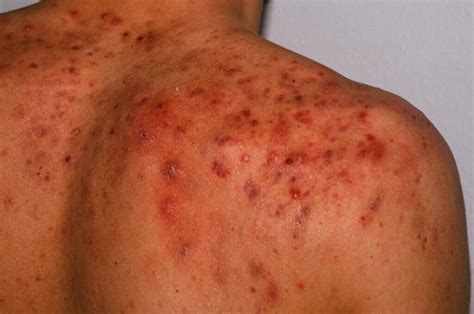 Mild Cystic Acne On Back