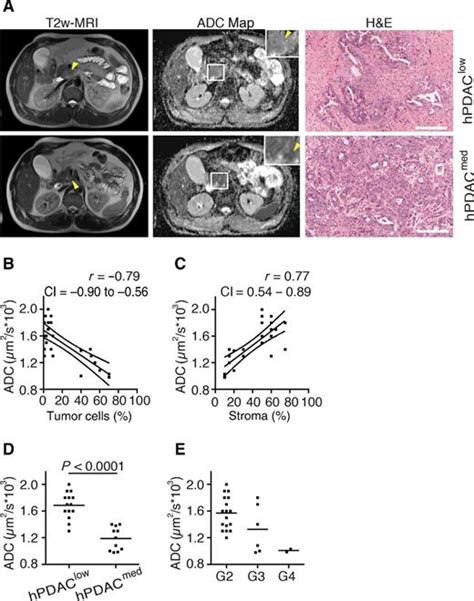Co Clinical Assessment Of Tumor Cellularity In Pancreatic Cancer