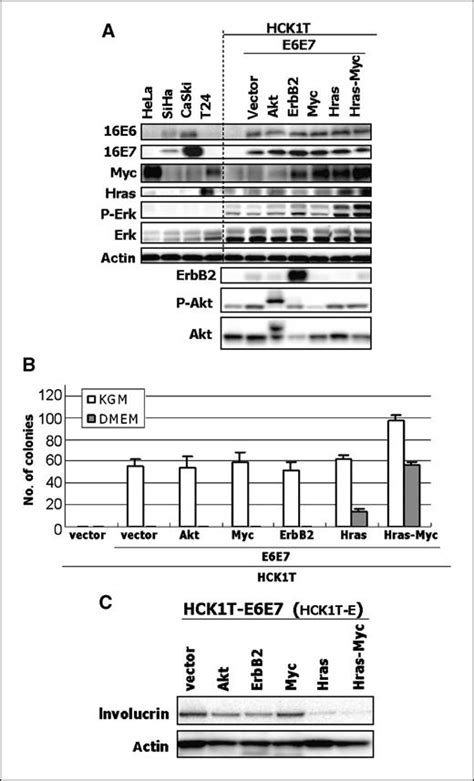 An In Vitro Multistep Carcinogenesis Model For Human Cervical Cancer