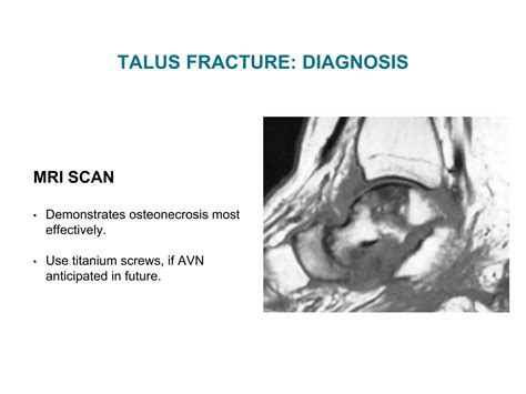 Talus Fracture Treatment Algorithm Pptx Death Injury Or Military