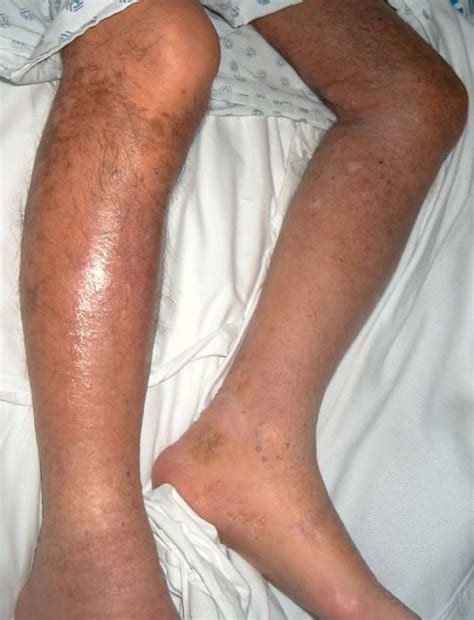 Nice Sarcoma Bruise Verry Good