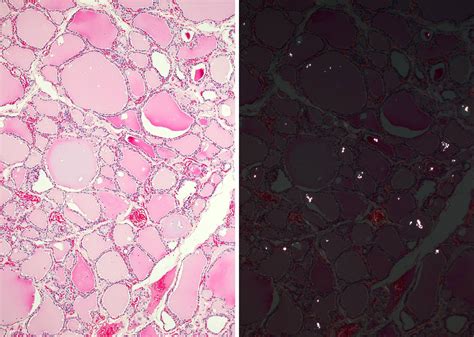 Pathology Outlines Calcification