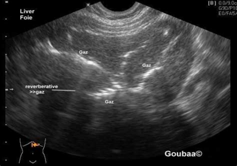 Biliary System Pathology Flashcards Quizlet