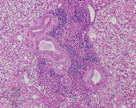 Pericholangitis In Hypereosinophilic Syndrome Cat