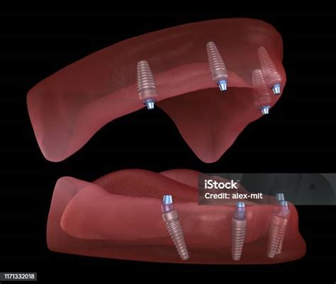 잇몸과 만디블러 보철물로 임플란트가 지원하는 4가지 시스템 인간의 치아와 의치의 의학적으로 정확한 3d 그림 Edentulous