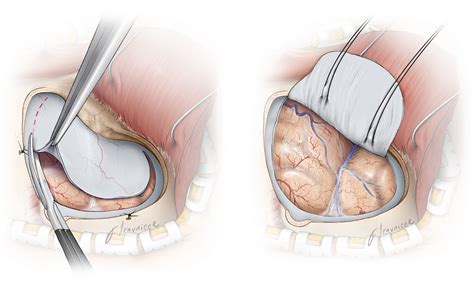 Awake Craniotomy Expert Surgeon Aaron Cohen Gadol Md