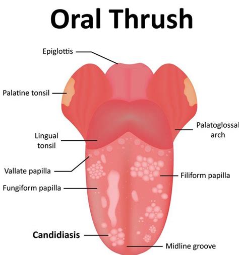 Thrush Treatment Natural Remedies Nutrition Wellness Center