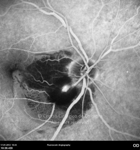Clinical Case 3 Atlas Rl Eye