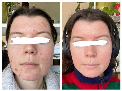 Hydroquinone X Tretinoin R Tretinoin