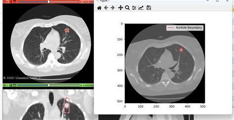 Using Monai Label To Fine Tune The Vessel Segmentation Support 3d