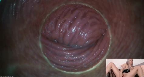 Pussy Endo Thisvid Com