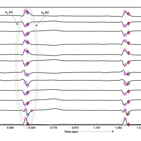 Qrs Complex Detection By Single Lead Detector And Multi Lead Detector