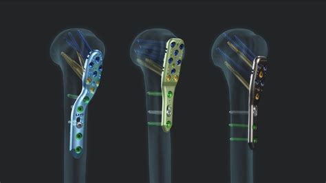 Arthrex Proximal Humerus Plating System