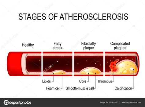 Atherosclerosis Plaque Formation