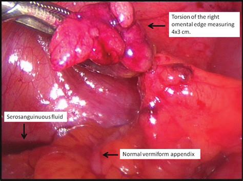 Torted Right Omental Edge And Typical Serosanguinous Fluid Also Note