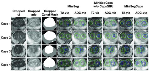 Visualization Of Benign Nodule Eg Bph Segmentation Results Among