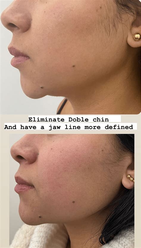 FAT REMOVAL Clinique Grace