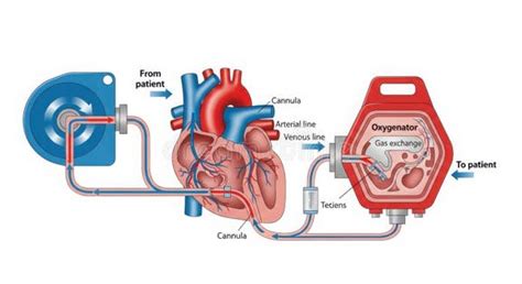 Extracorporeal Membrane Oxygenation Heart Lung Machine Diagram Stock