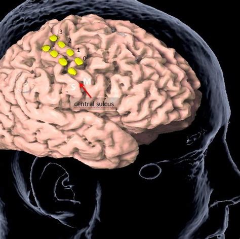 Topics Department Of Neurosurgery Radboud University Medical Center