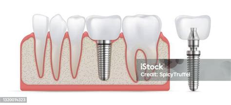 치과 용 임플란트 치아 관리 수술 및 크라운 기구 치아 교체 및 보철 처리 금속 나사로 인공 어금니의 이식 틀니 모델 벡터 스토마토로지 치아 건강에 대한 스톡 벡터 아트 및