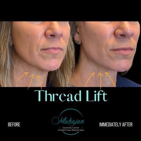 Thread Lift — Golden Glow Medical Spa