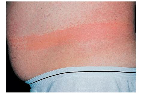 Простой контактный дерматит причины симптомы диагностика и лечение