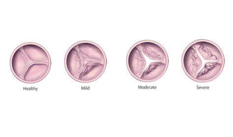 Aortic Stenosis And Treatment Options Medicus Network Find Your Medical Specialist In Singapore
