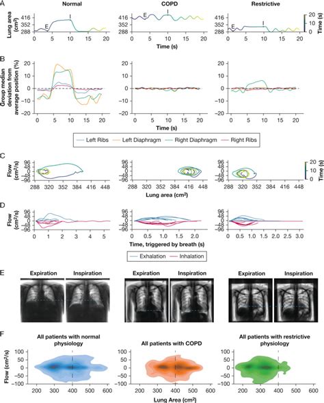 Dynamic Digital Radiography Pulmonary Function Testing Chest Pulmonary