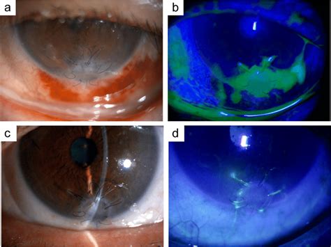 Slit Lamp Photographs Of A Case Of Ldak A B Corneal Graft Is Melting Download Scientific