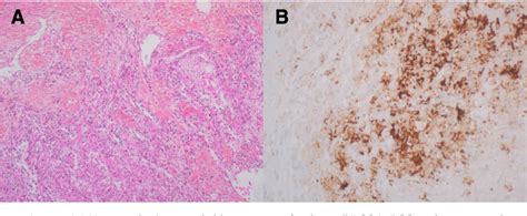 Sarcomatoid Carcinoma Of The Penis Semantic Scholar