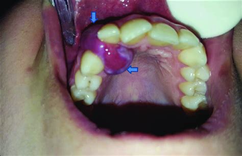 Intraoral Photograph Showing A Gingival Pyogenic Granuloma Download