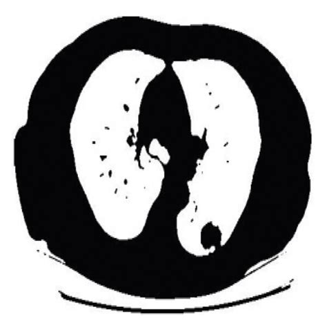 A Lung Volume After Fixed Thresholding B Lung Volume After Download Scientific Diagram