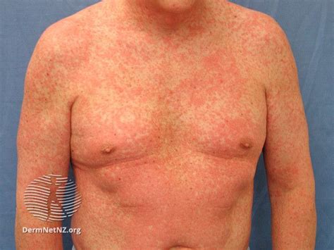 Maculopapular Rash Symptoms Causes Treatment