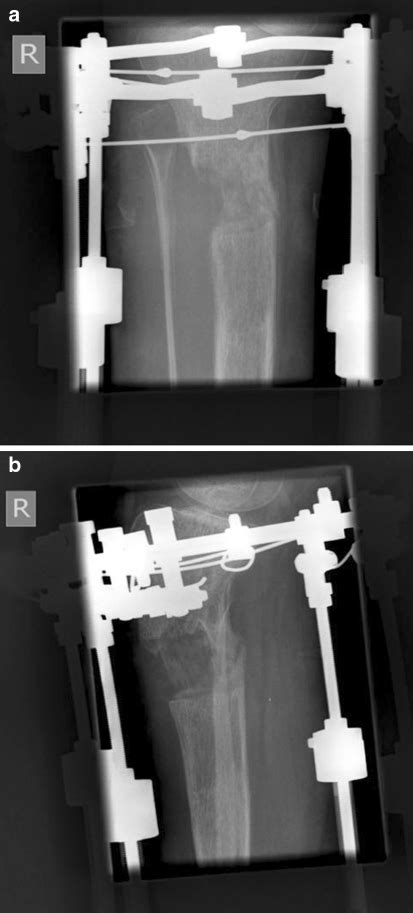 A Anteroposterior And B Lateral Radiographs Of The Proximal Tibia Download Scientific Diagram