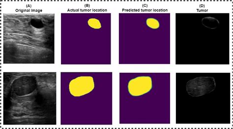 Automated Breast Tumor Ultrasound Image Segmentation With Hybrid Unet And Classification Using