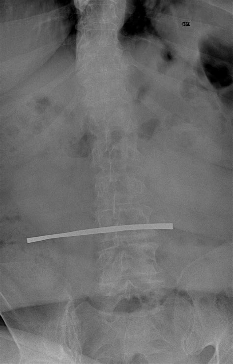x ray classification dataset by nathan yan