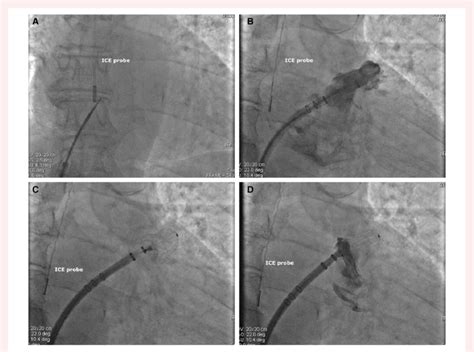 A Fluoroscopic Illustration Of The Intracardiac Echocardiography Download Scientific Diagram