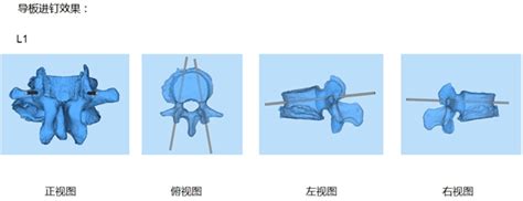 滦州市人民医院成功开展我市首例人工智能3d打印技术导引下脊柱矫形手术 医疗动态 滦州市人民医院