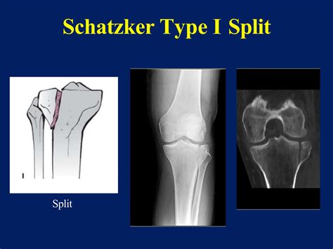 Proximal Tibia Fractures And Its Management Pptx