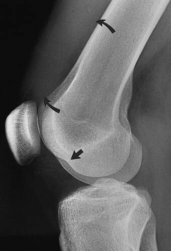 Sulcus Terminalis Femur