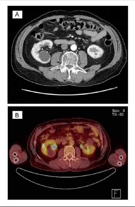 Figure From Oncocytic Papillary Renal Cell Carcinoma In The Background Of Renal Adenomatosis