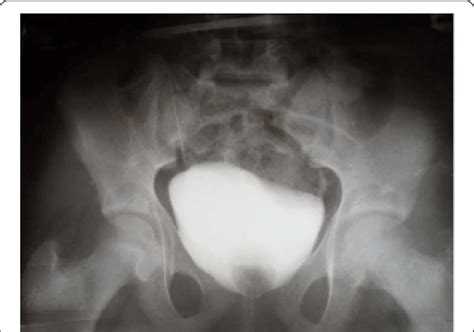 Micturating Cystourethrogram Download Scientific Diagram