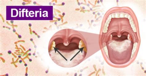 Jihajumi Difteria