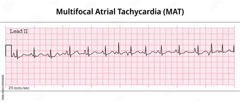 Multifocal Atrial Tachycardia Mat 8 Second Ecg Paper Electrocardiography Vector Medical